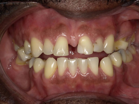 Dental Case Studies at Dental Lab in Atlanta, GA