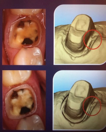 Intraoral Scanning Best Practices: IO Scanning Overview