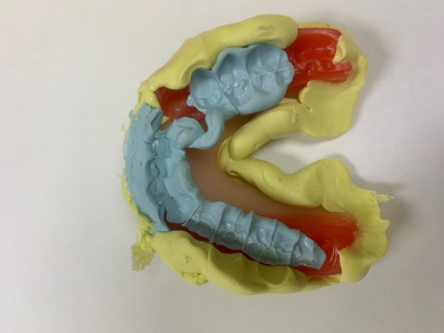 Explore the Various Wash Impression Best Practices