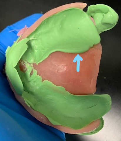 Explore the Various Wash Impression Best Practices