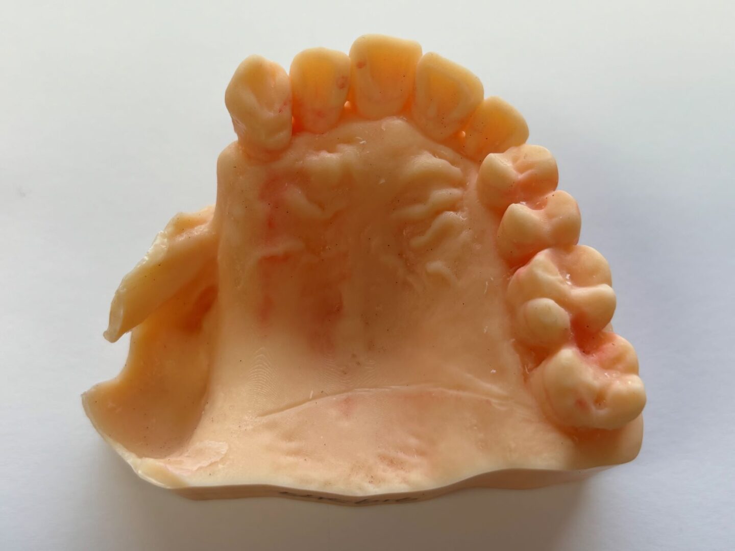 Palatal Obturators by Global Dental Solutions